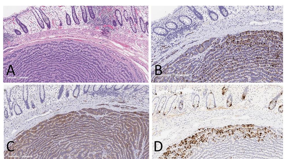 (PDF) Overview of the 2022 WHO Classification of Neuroendocrine Neoplasms