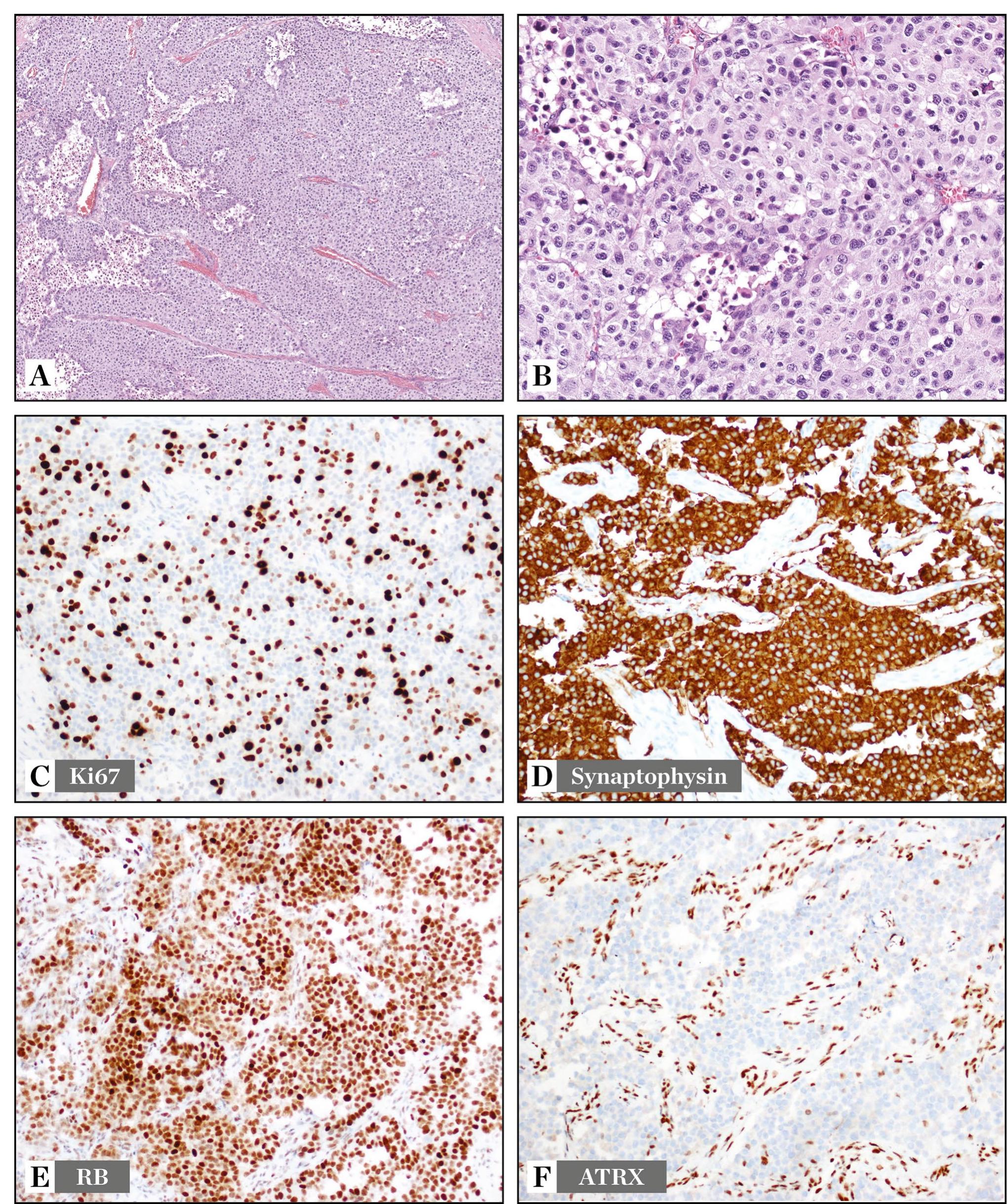 (PDF) Overview of the 2022 WHO Classification of Neuroendocrine Neoplasms