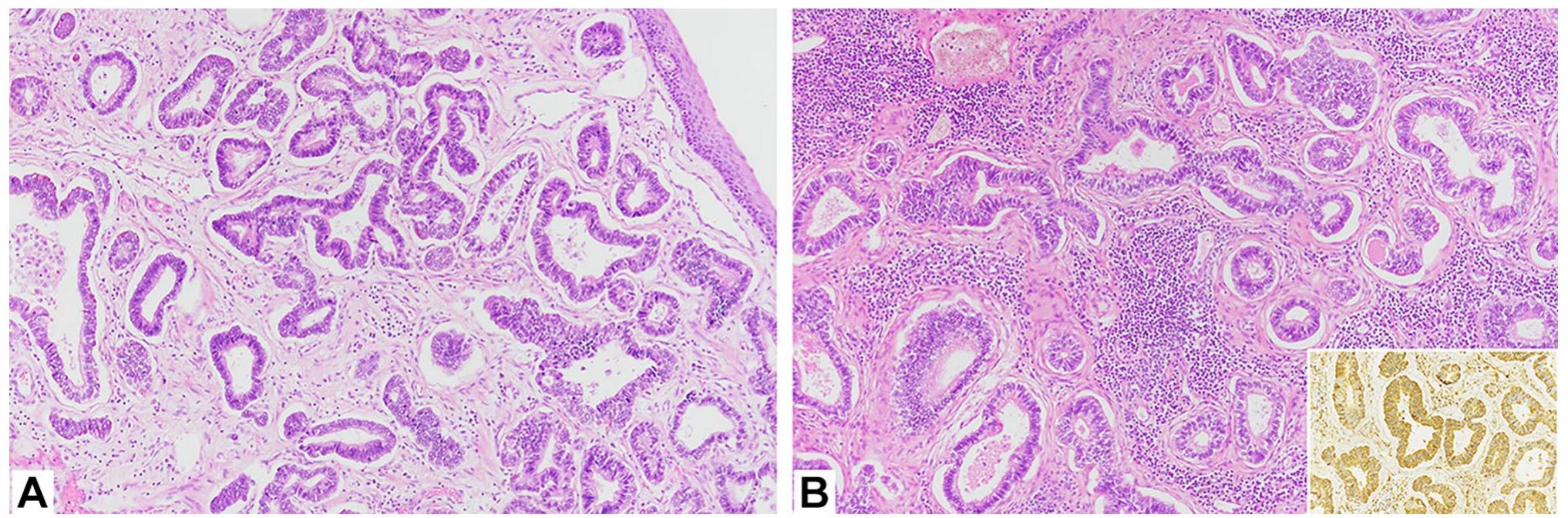 (PDF) Overview of the 2022 WHO Classification of Neuroendocrine Neoplasms