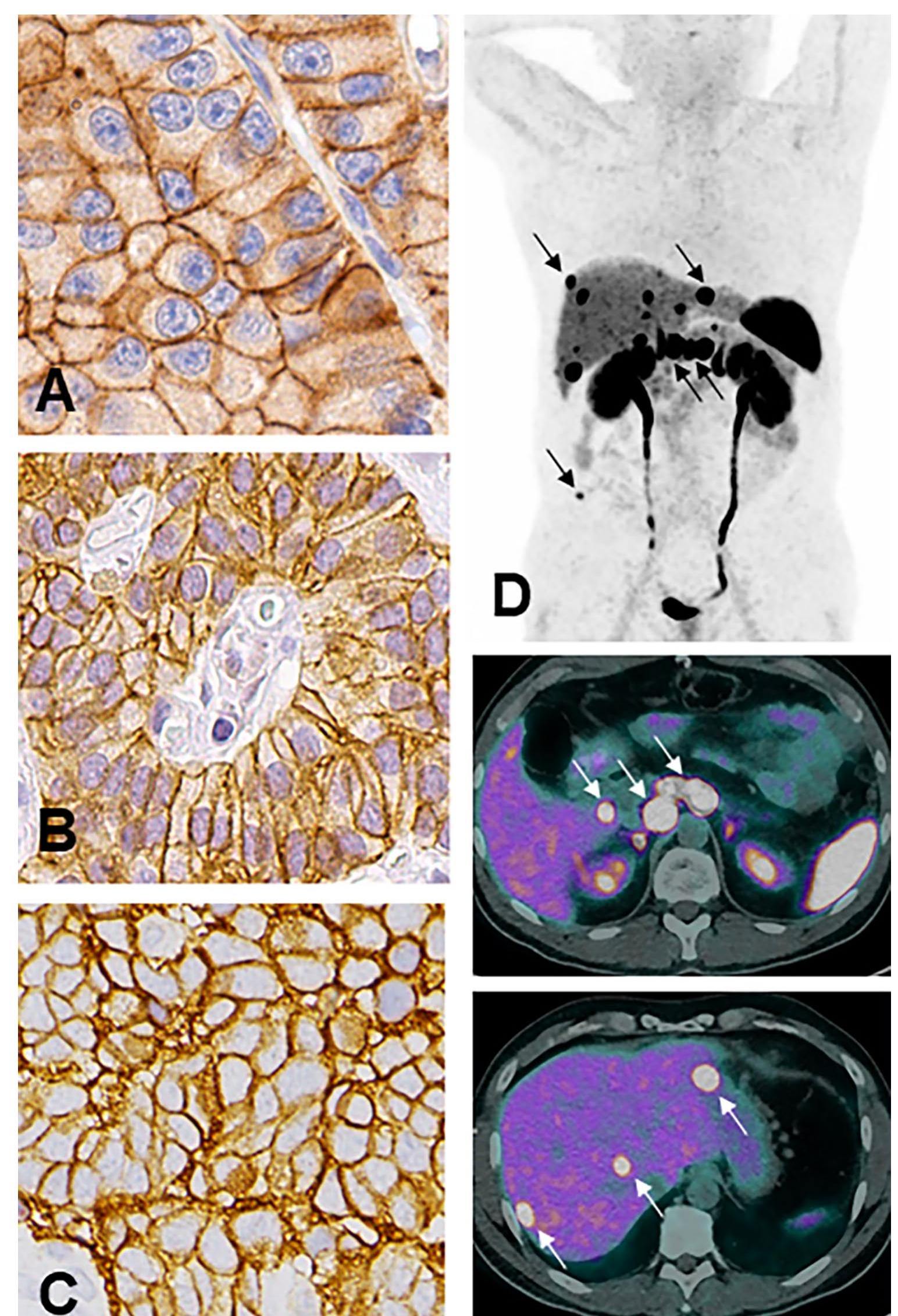 (PDF) Overview of the 2022 WHO Classification of Neuroendocrine Neoplasms