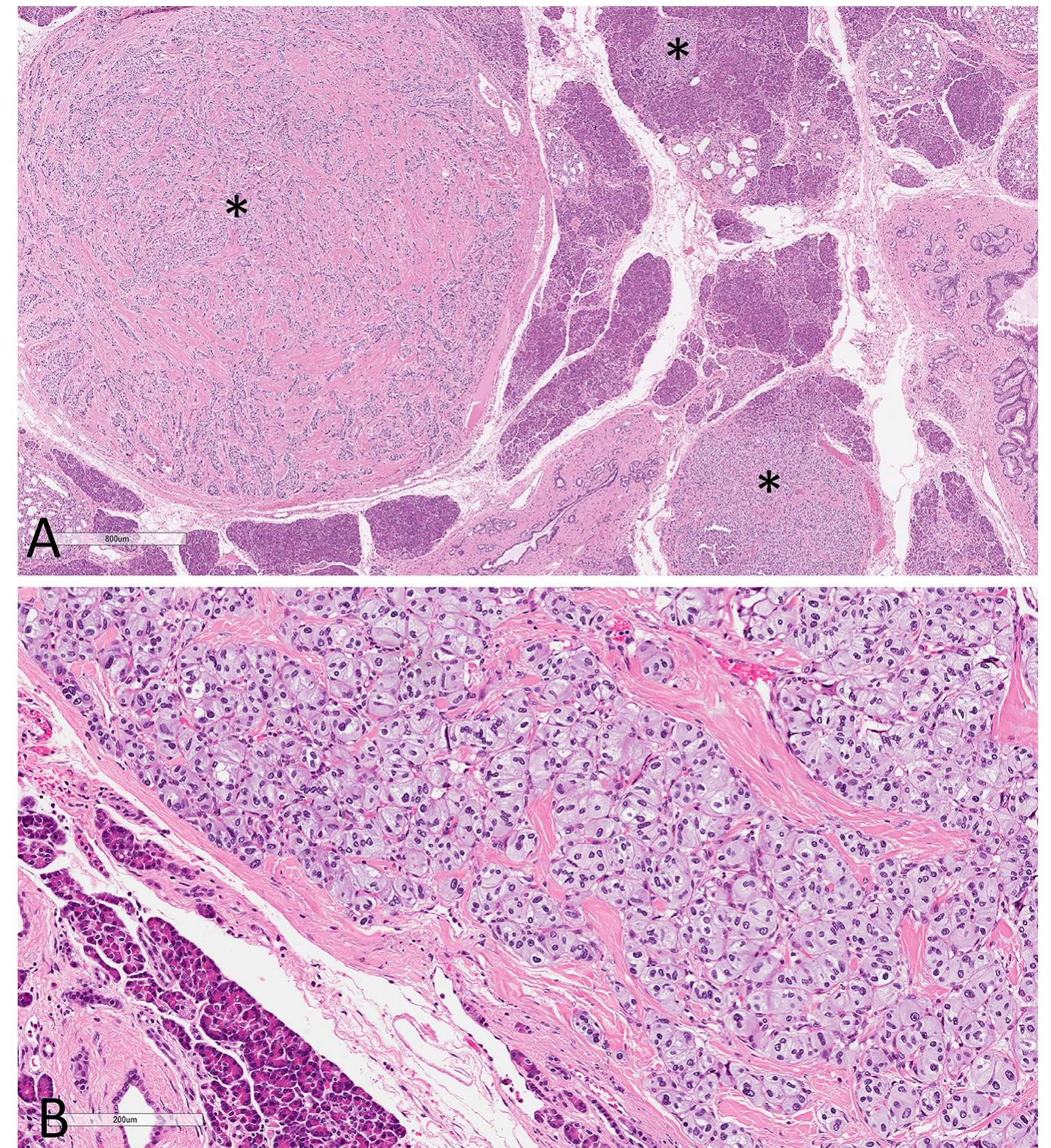 (PDF) Overview of the 2022 WHO Classification of Neuroendocrine Neoplasms