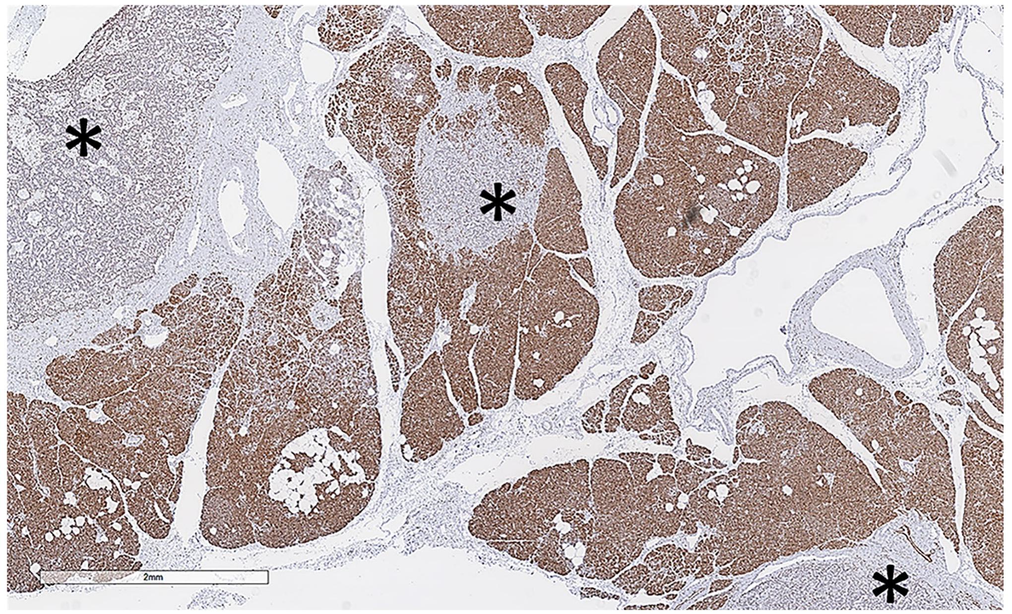 (PDF) Overview of the 2022 WHO Classification of Neuroendocrine Neoplasms