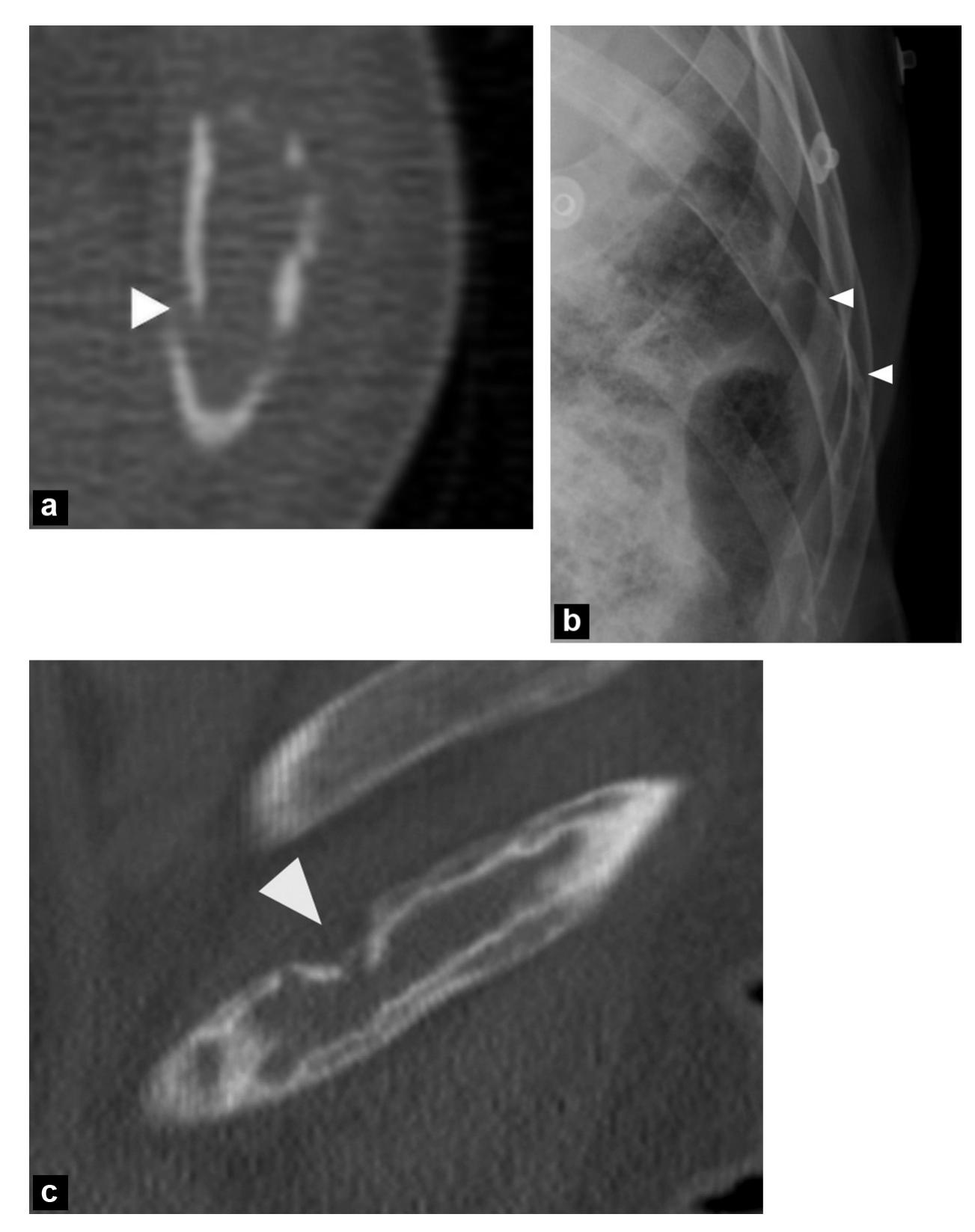Fibrous dysplasia. a: 37-year-old patient, axial ct.
