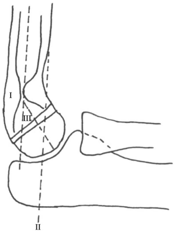 (a) (i) teardrop sign. (b) (ii) anterior humeral line. (c)