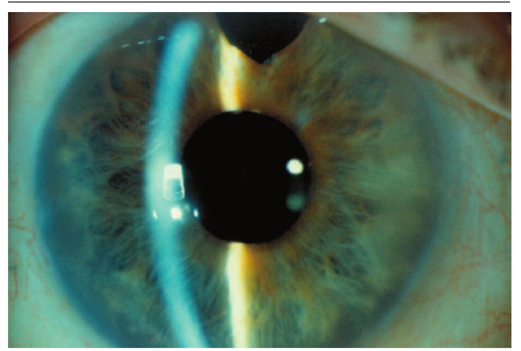 Transscleral sutured posterior capsule intraocular lens