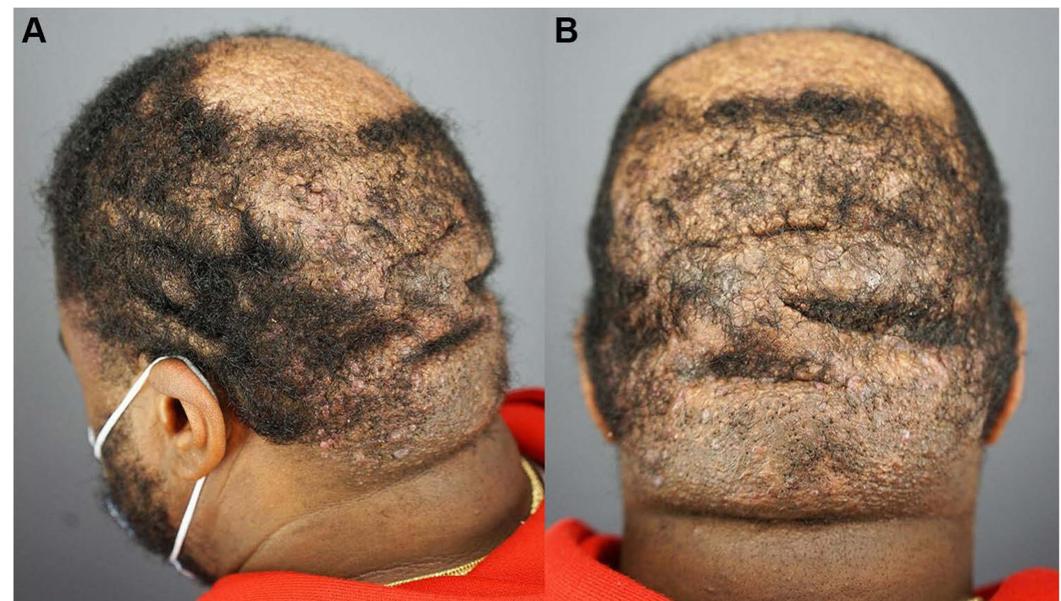 | cvg and widespread akn papular lesions: patient | with cvg
