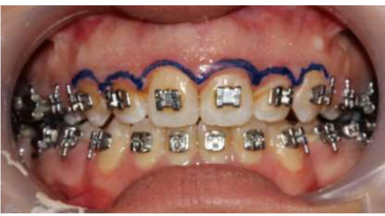(1b): photo showing markings of the new gingival margins