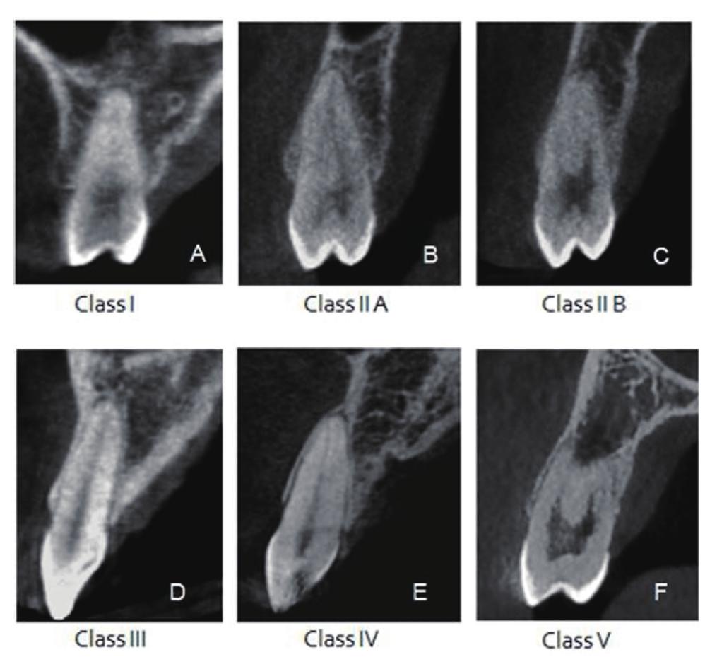 Tooth root positions for maxillary anterior teeth, including