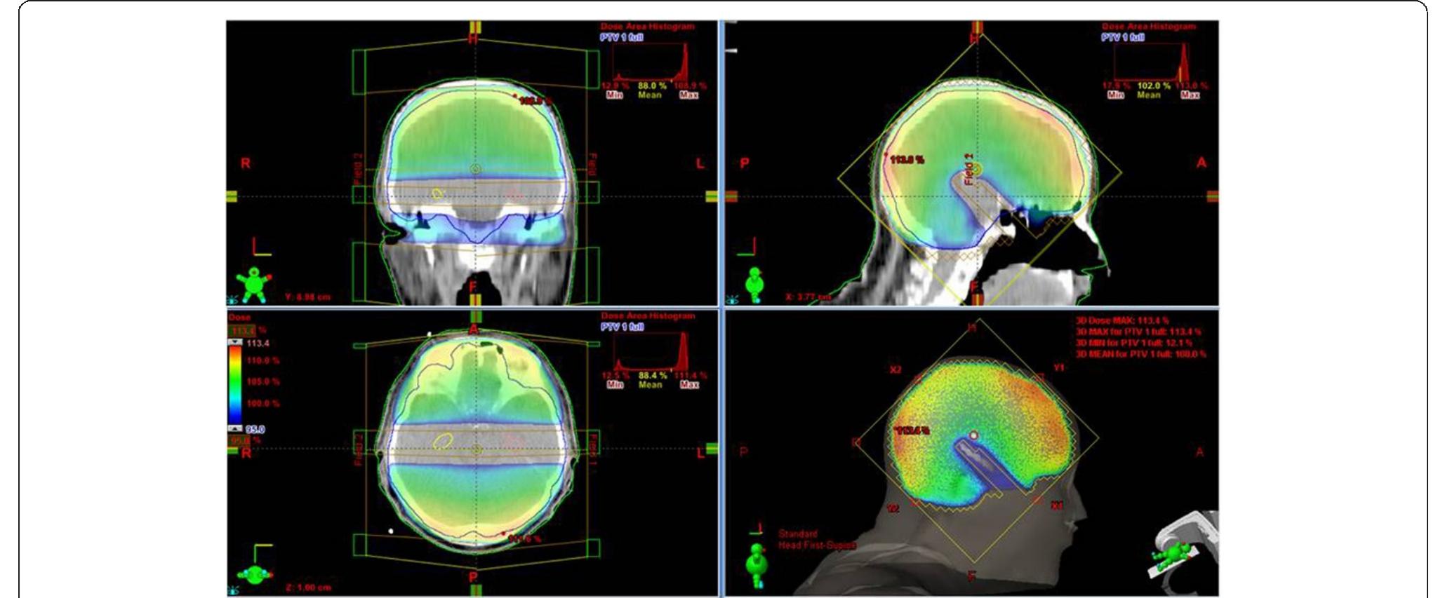 Simple rt technique using 2 laterolateral brain fields with
