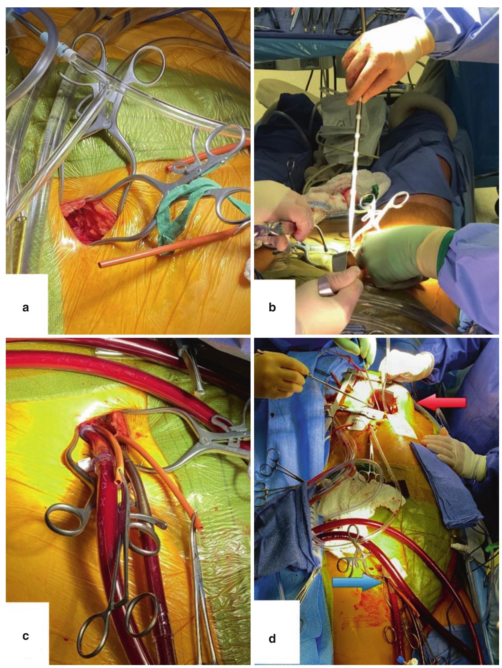 And vein are cannulated. (d) femoro-femoral bypass (blue
