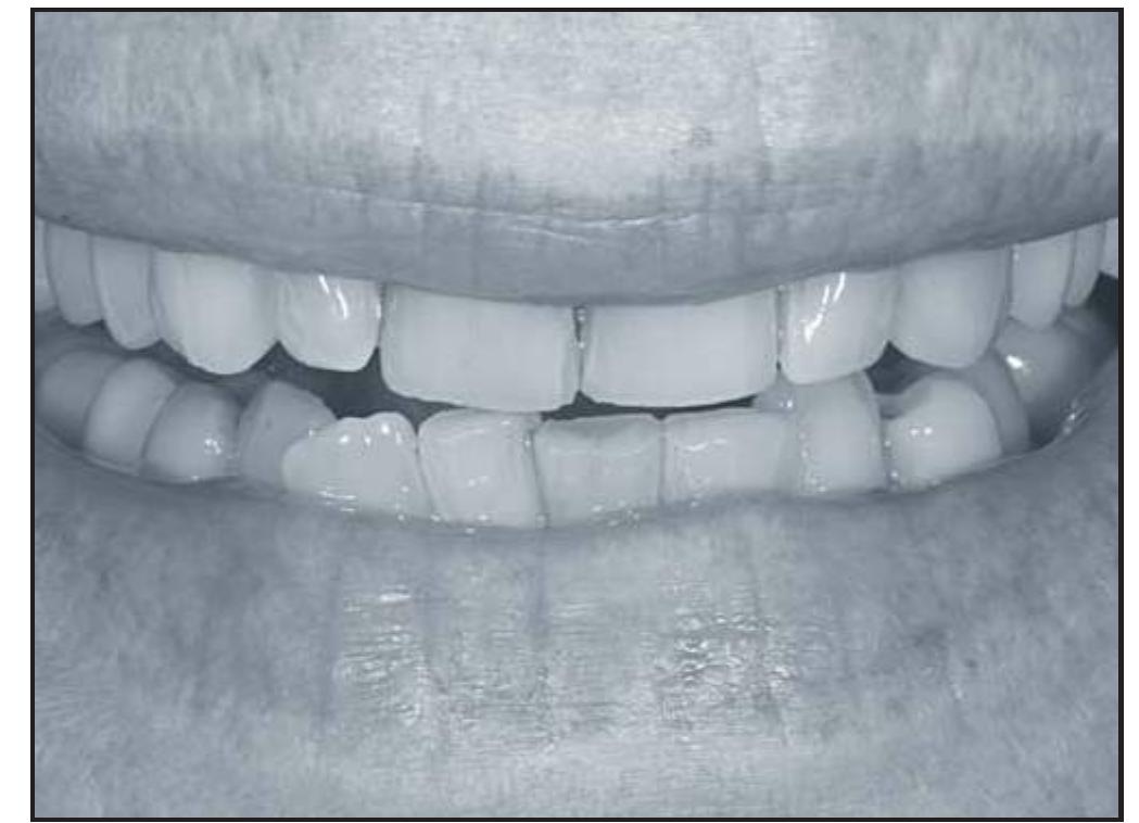 Mandibular anterior tooth display increases with age. a