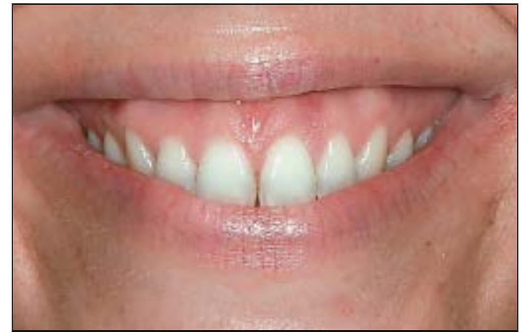 Egd(b) degree 1 with 2 to 4 mm of gingival display.