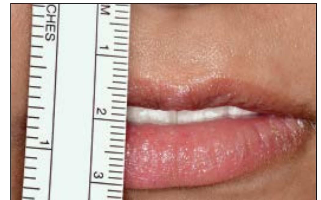 Length of the upper lip (subnasale to lower border) is