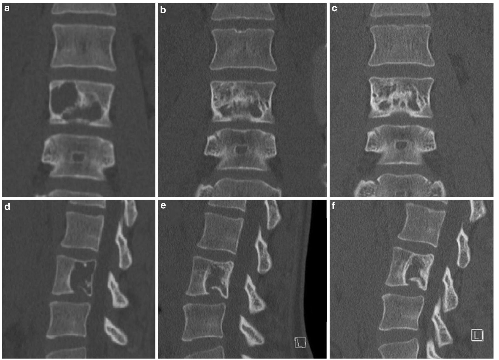 Coronal (top) and sagittal (bottom) ct scans of a patient