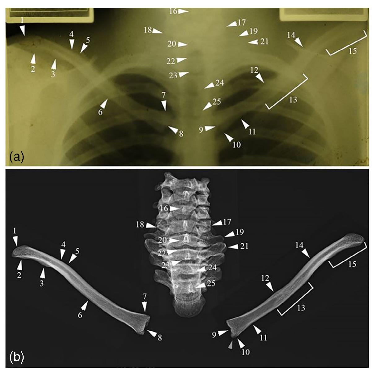 _ example of a chest radiograph comparison. (a) antemortem