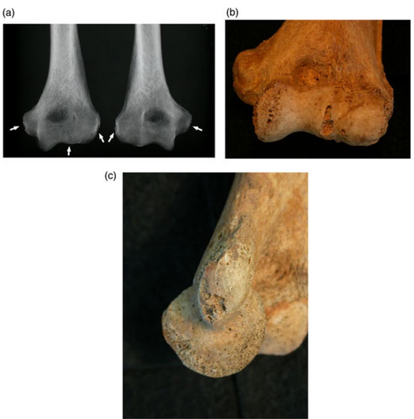 (a) antero-posterior radiograph of the distal parts of both