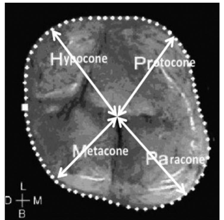 Primary cusps of maxillary first molar