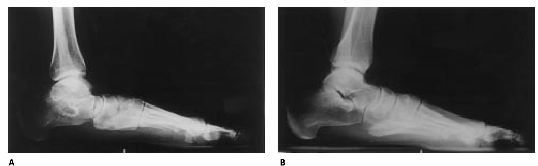 A, lateral weight- bearing radiograph of a foot with stage