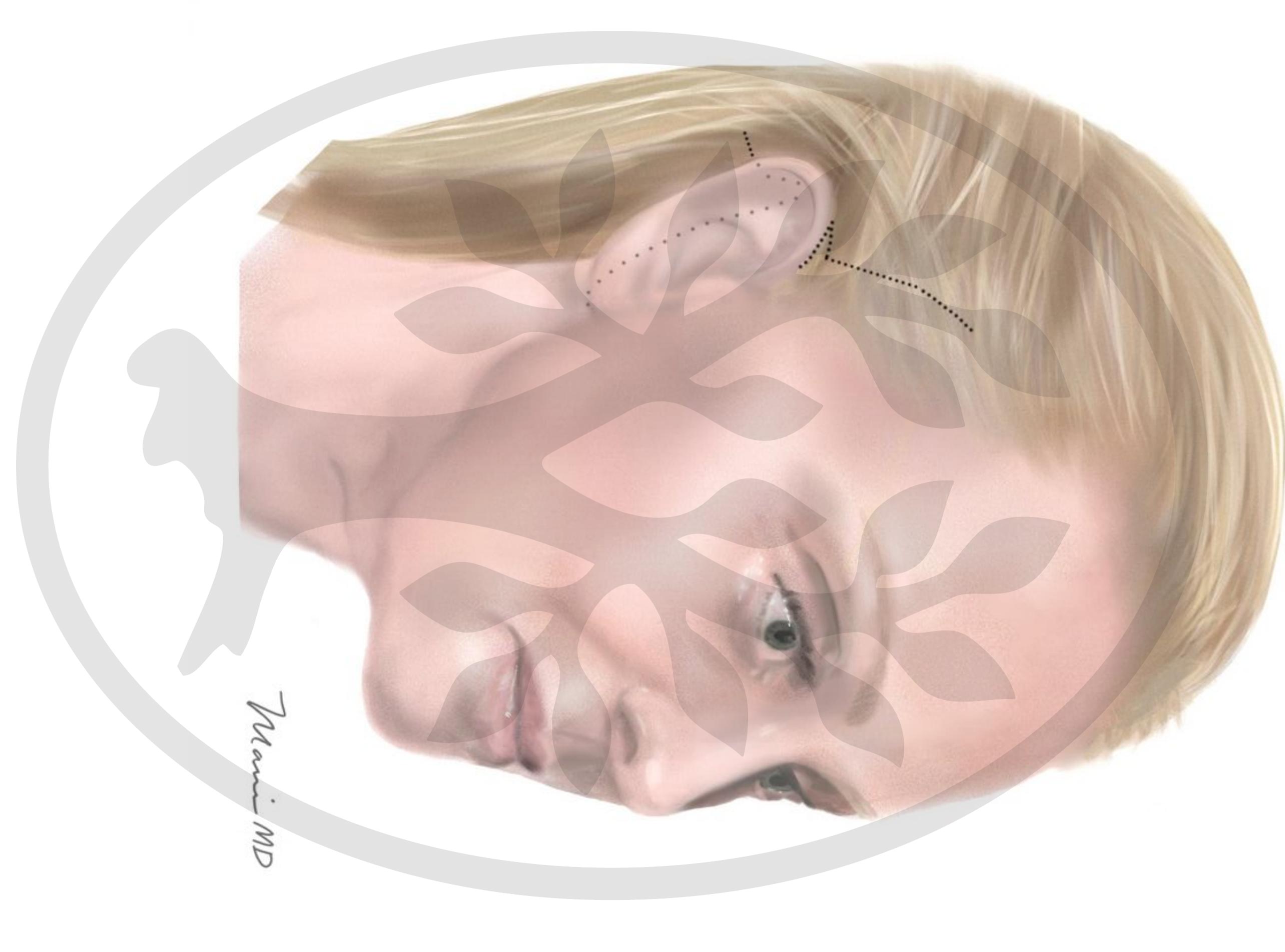 Figure 4 - Endoscopic, "Scarless" Composite Flap Face and