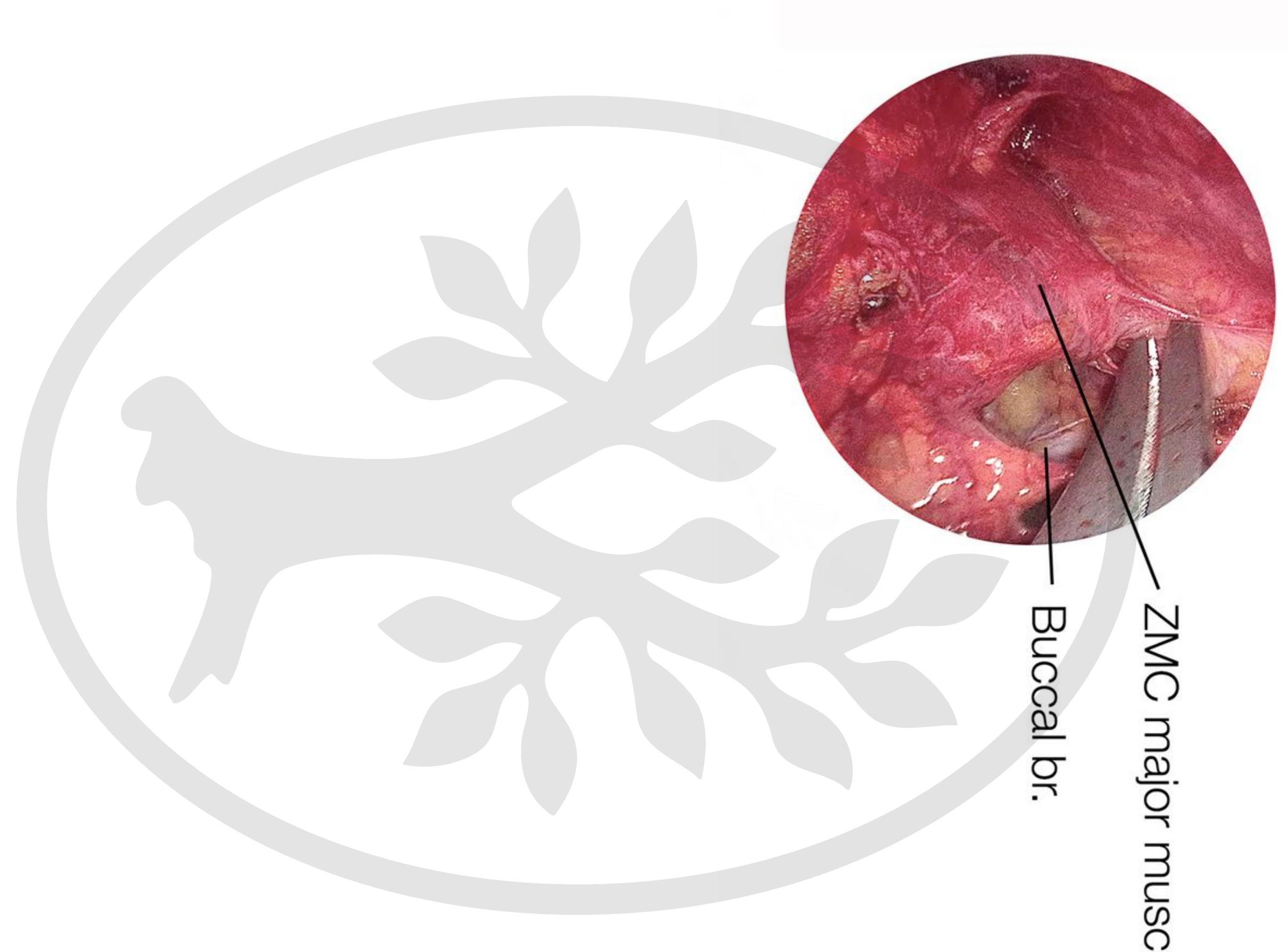 Figure 6 - Endoscopic, "Scarless" Composite Flap Face and
