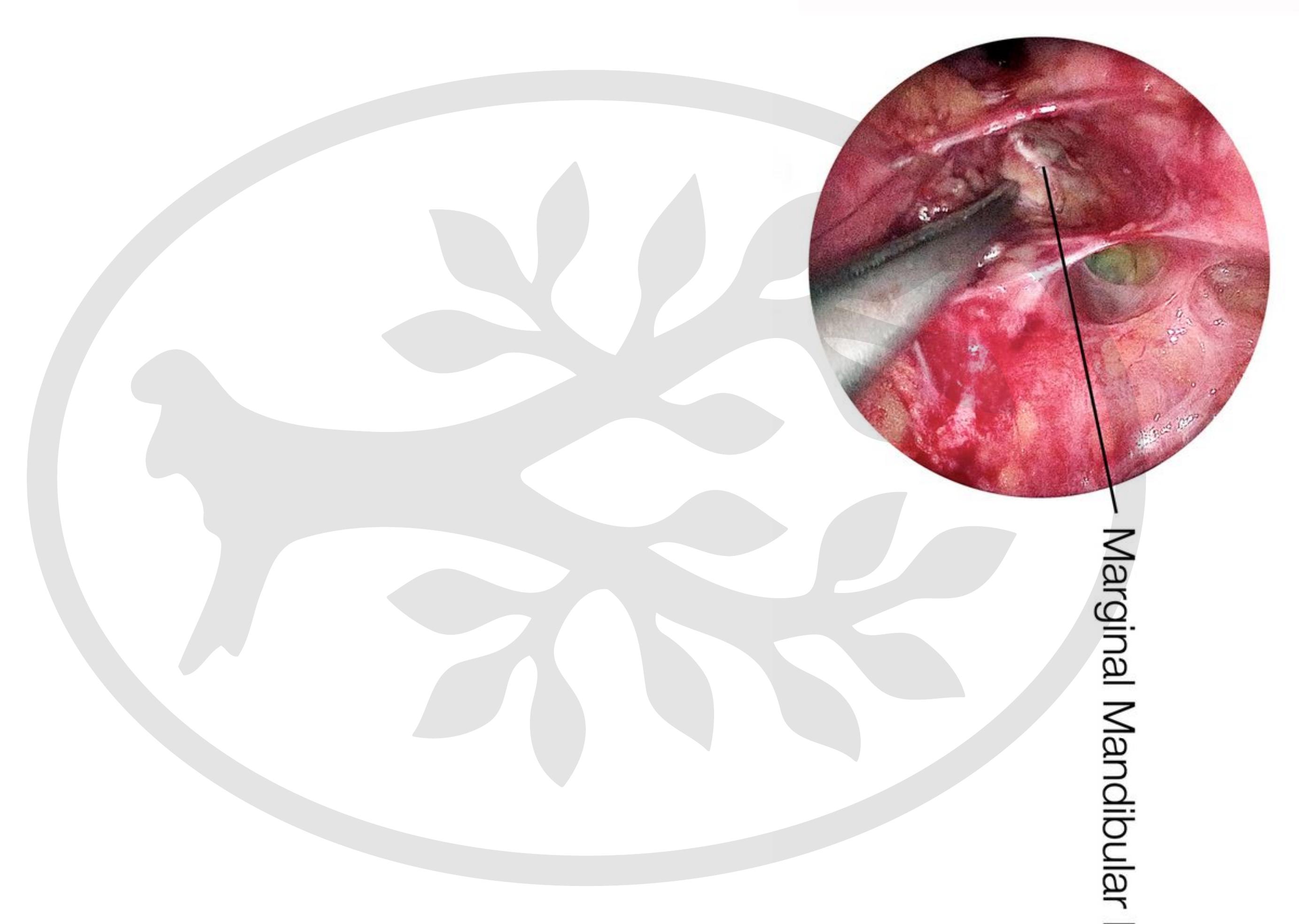 Figure 8 - Endoscopic, "Scarless" Composite Flap Face and
