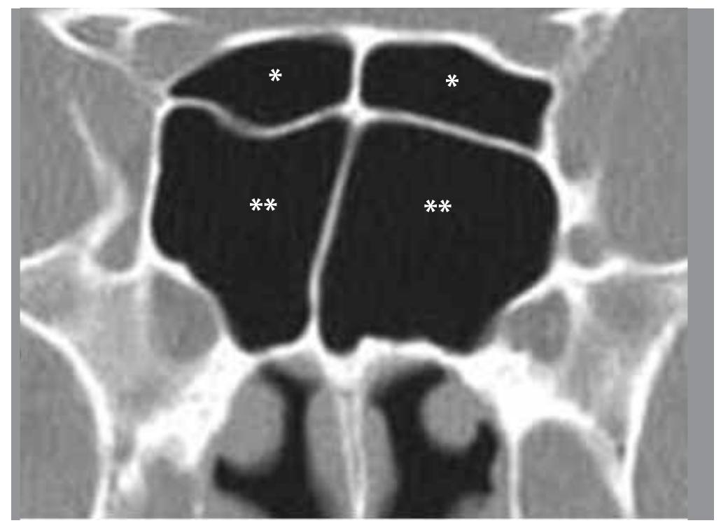 Sohenoethmoidal (onodi) cell (*) and sphenoid sinus (**).