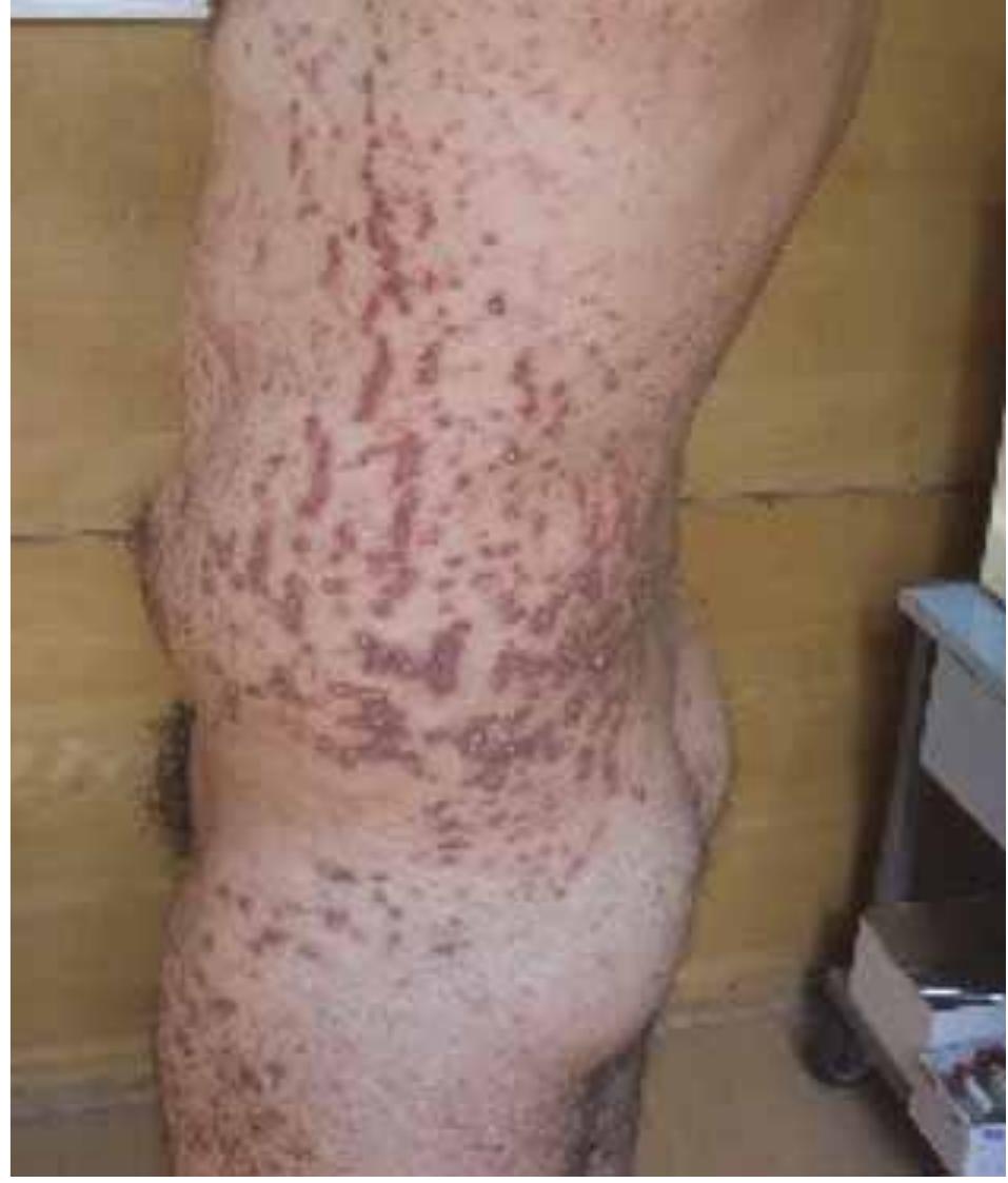 Lesions on the lateral aspects of the trunk