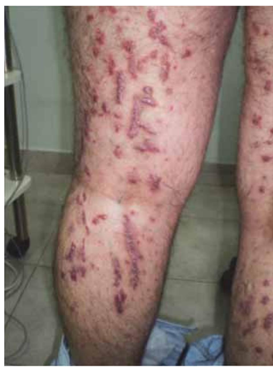 Skin lesions after acitretin therapy