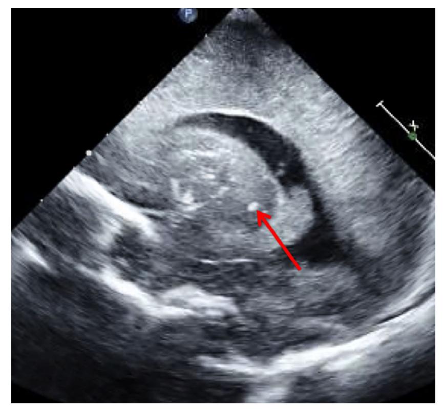Sagittal view of the neonatal cranial ultrasound showing