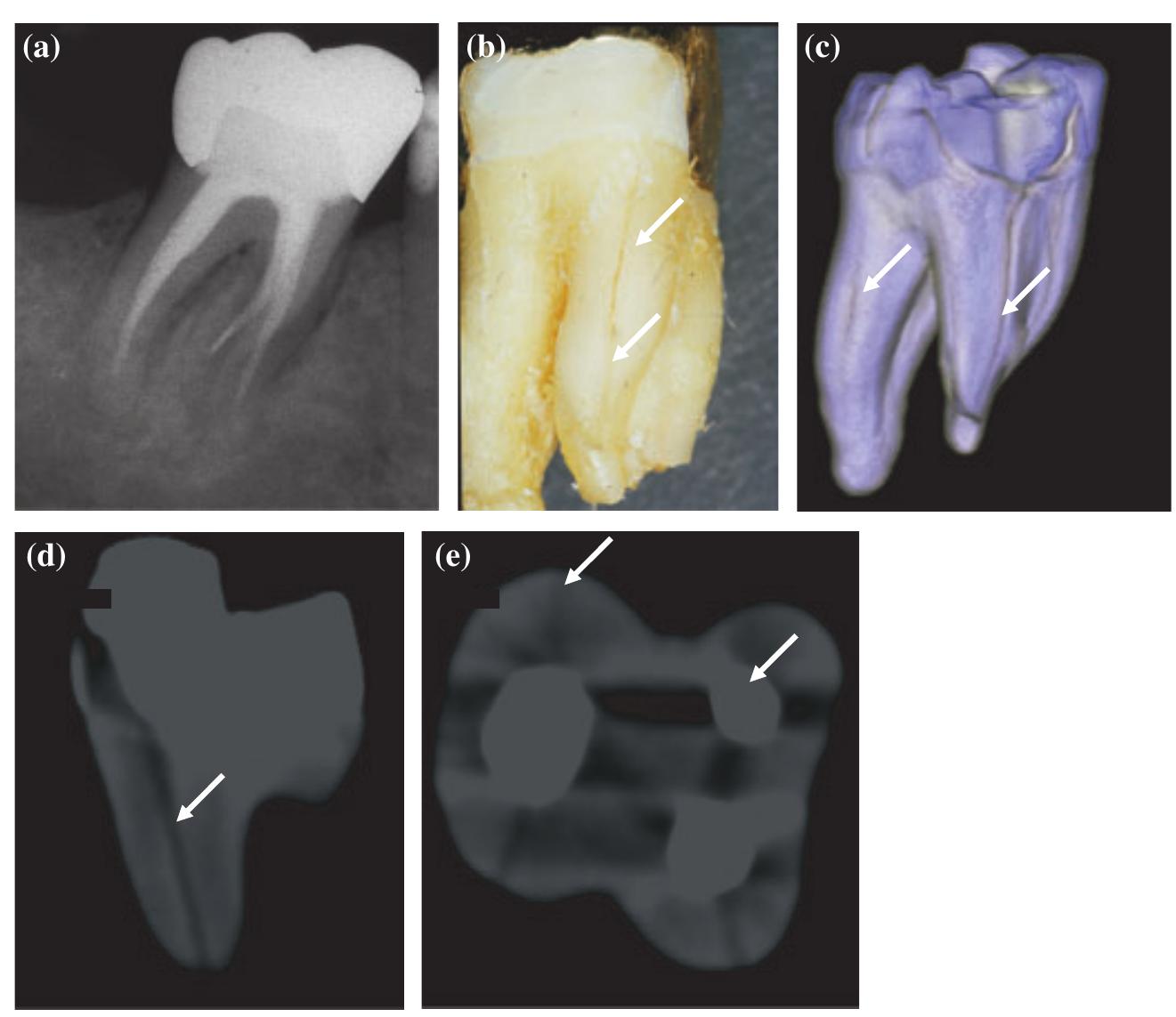 Tooth e: first mandibular molar. (b) vertical cracks in