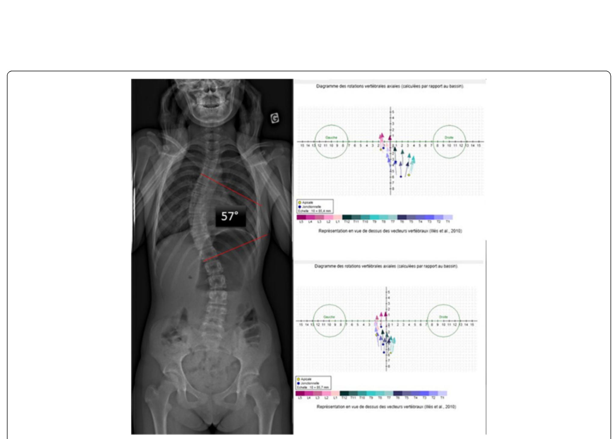 3 curves scoliosis: main thoracic curve with 2 minor