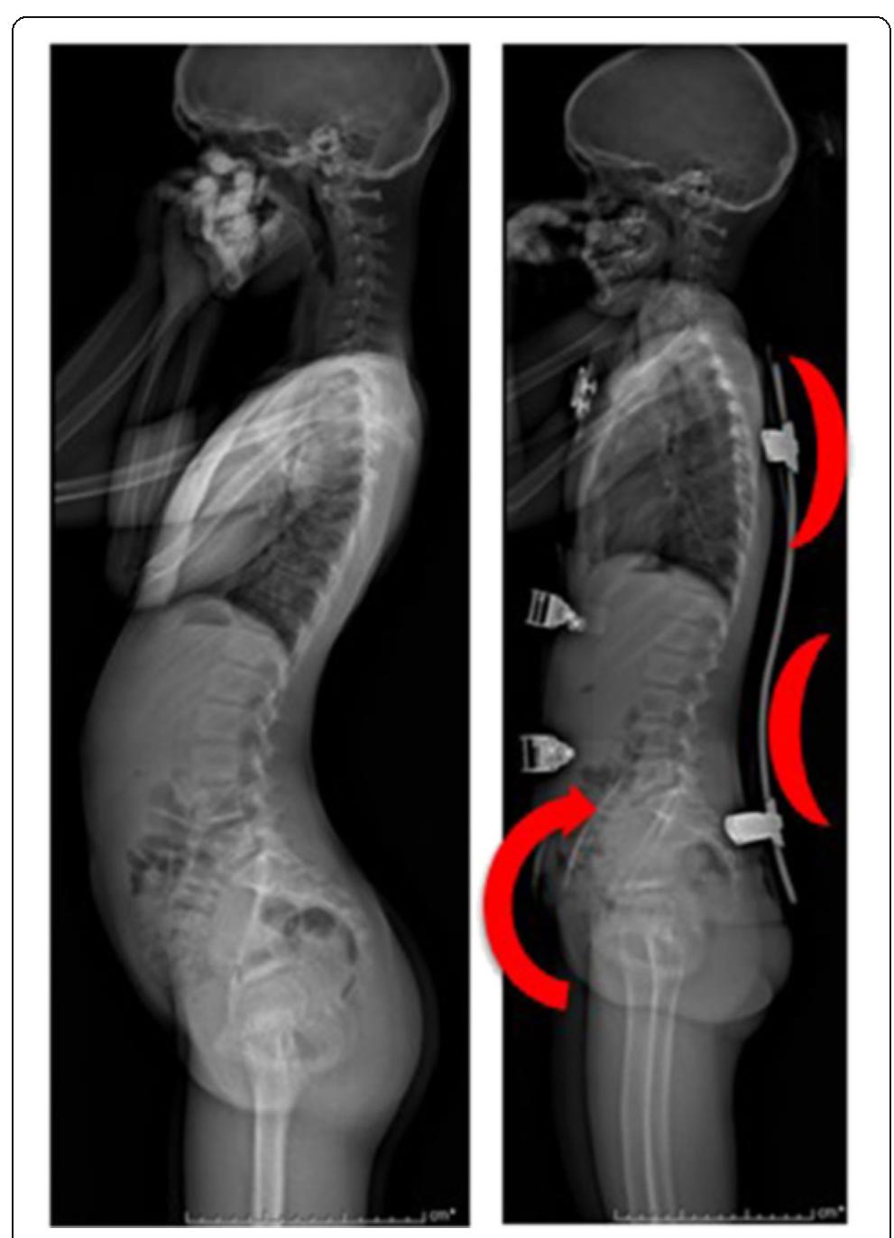Thrust fig. 94 sagittal plane normalization with regional