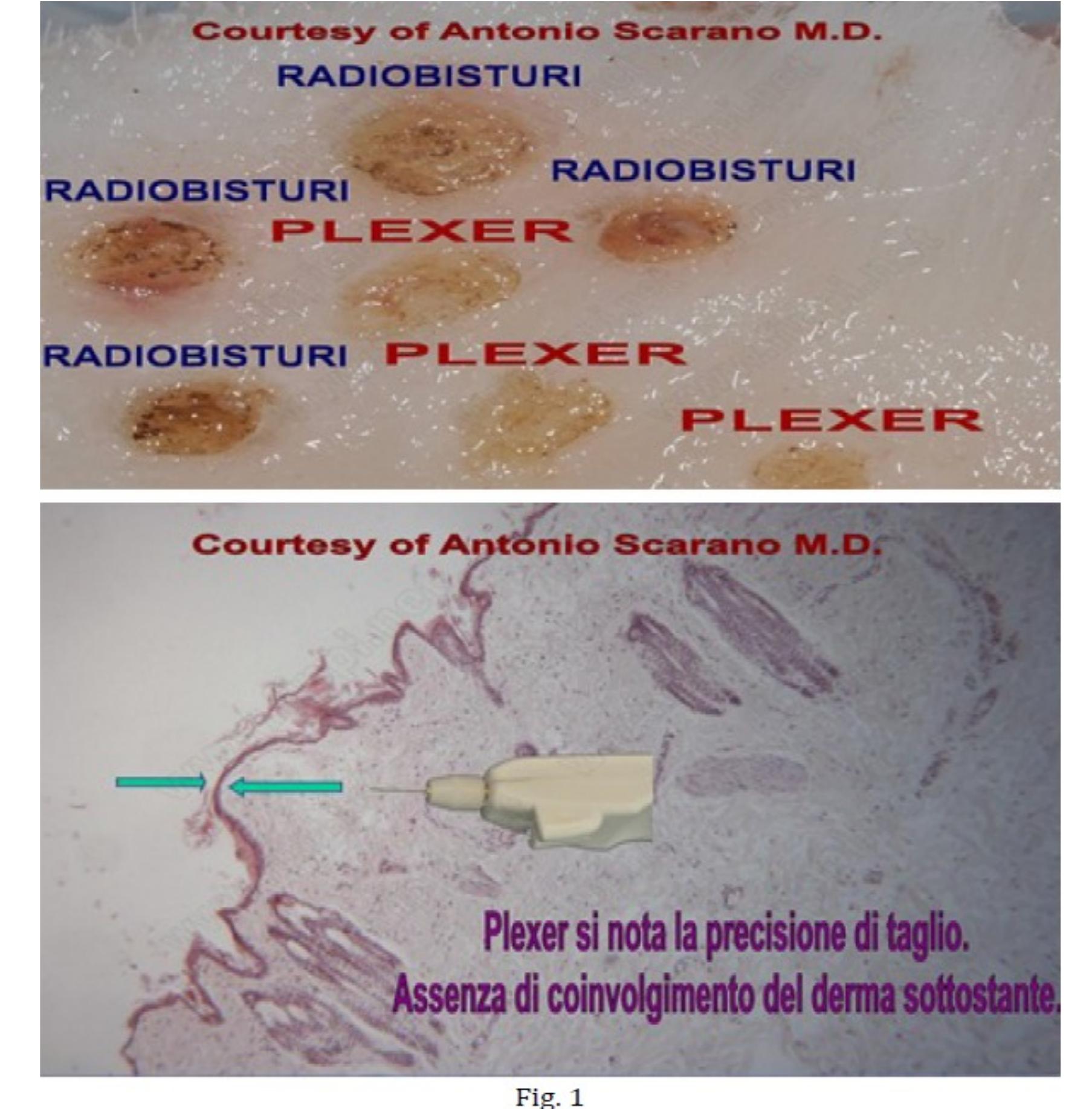 The results showed that plexr creates no lesions by heat in