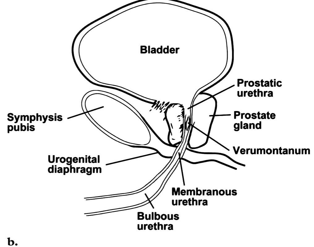 ‘igure 7. type iv urethral injury from blunt trauma. a)