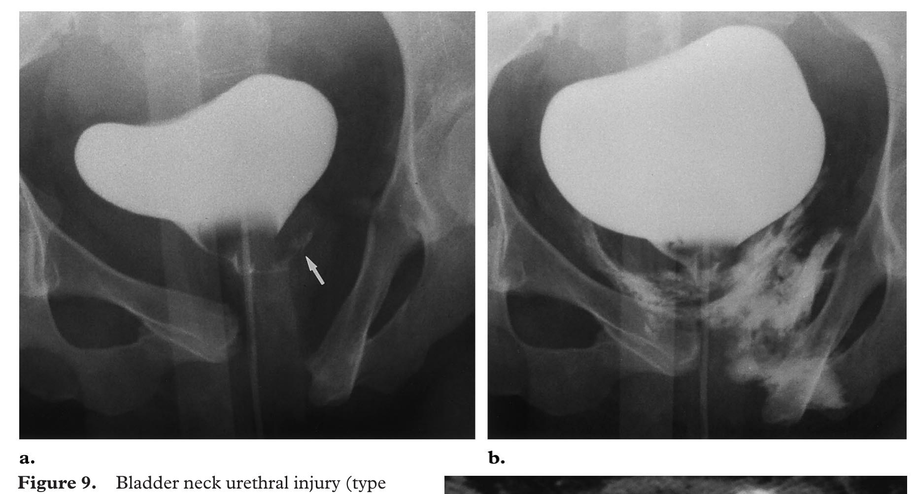 Figure 12 - Imaging of Urethral Disease: A Pictorial Review