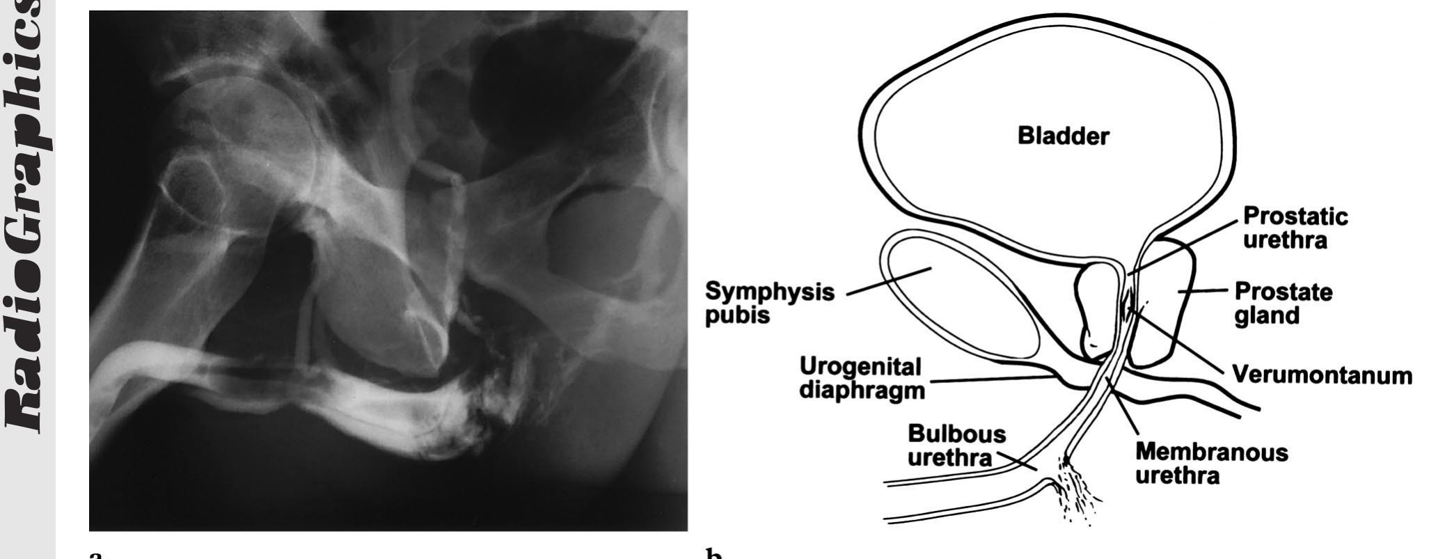 Anterior urethral injury following blunt trauma (type v