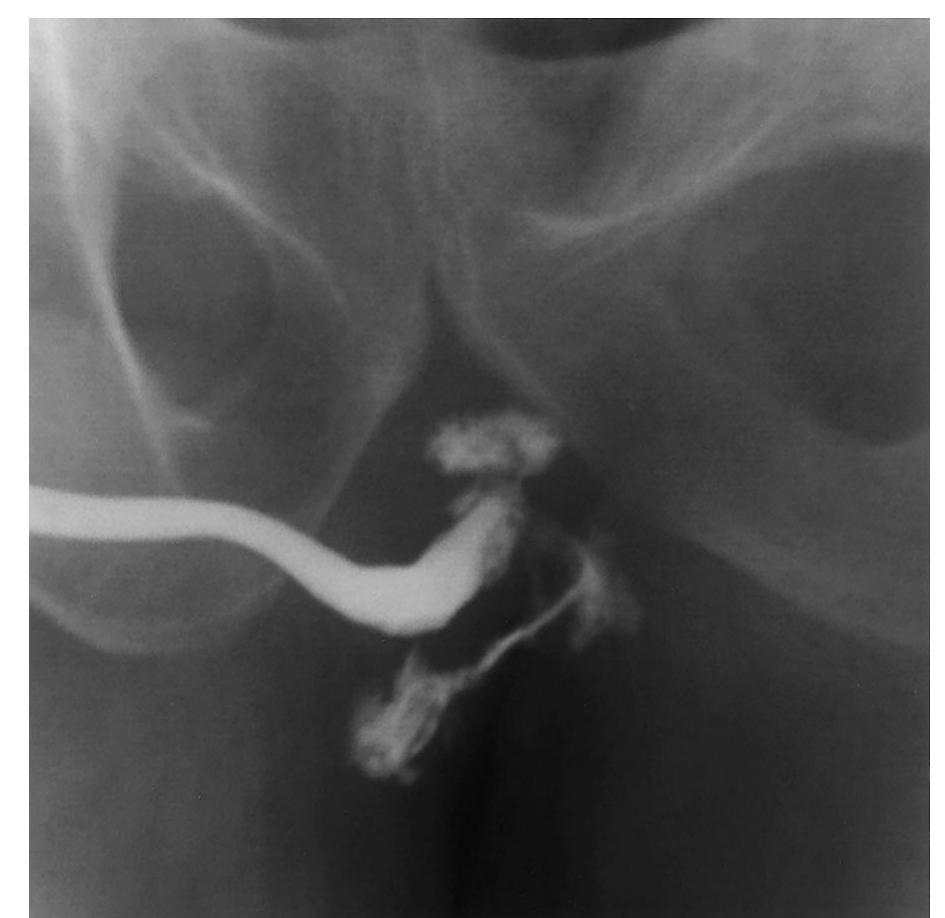 Figure 20 - Imaging of Urethral Disease: A Pictorial Review