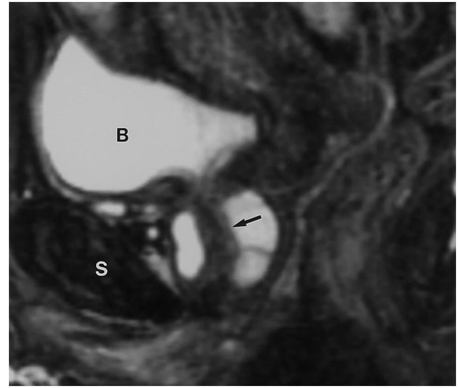 Urethral diverticulum (female prostate sign). sagittal fast