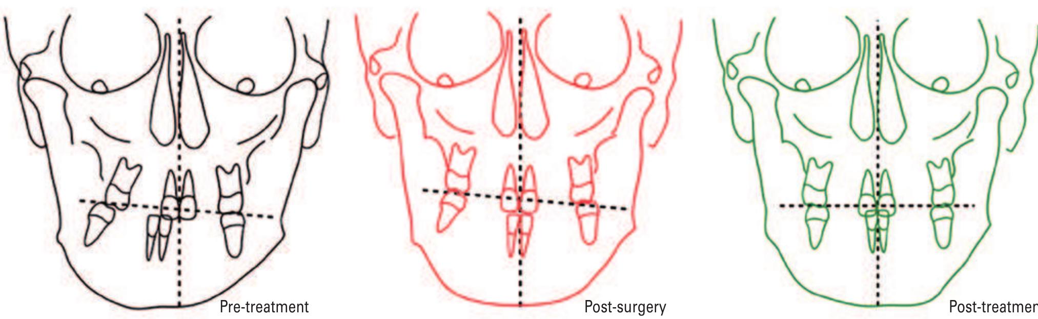 Figure 12 - Condylectomy, surgery first, and maxillary