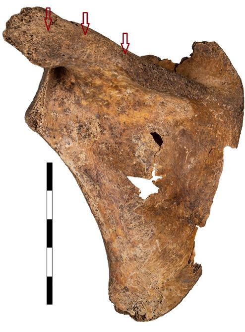Periostitis: abnormal porosity on the scapular spine (left