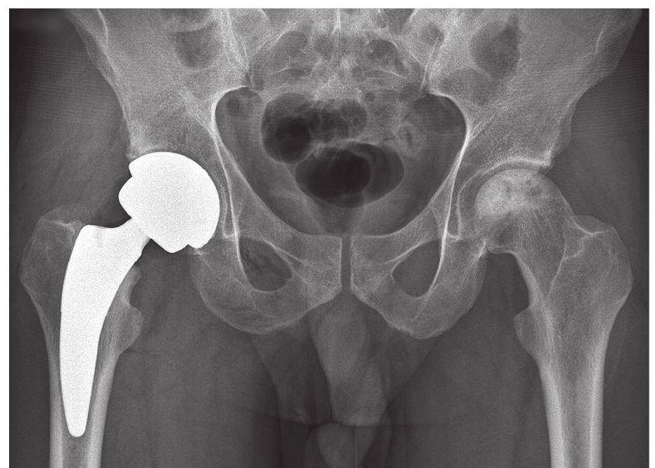The maxera™ acetabular system with fitmore® hip stem and a