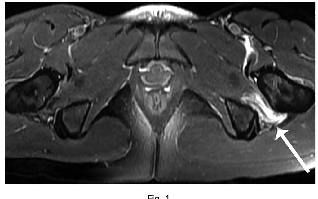 T,-weighted axial mri section of the proximal femur. the
