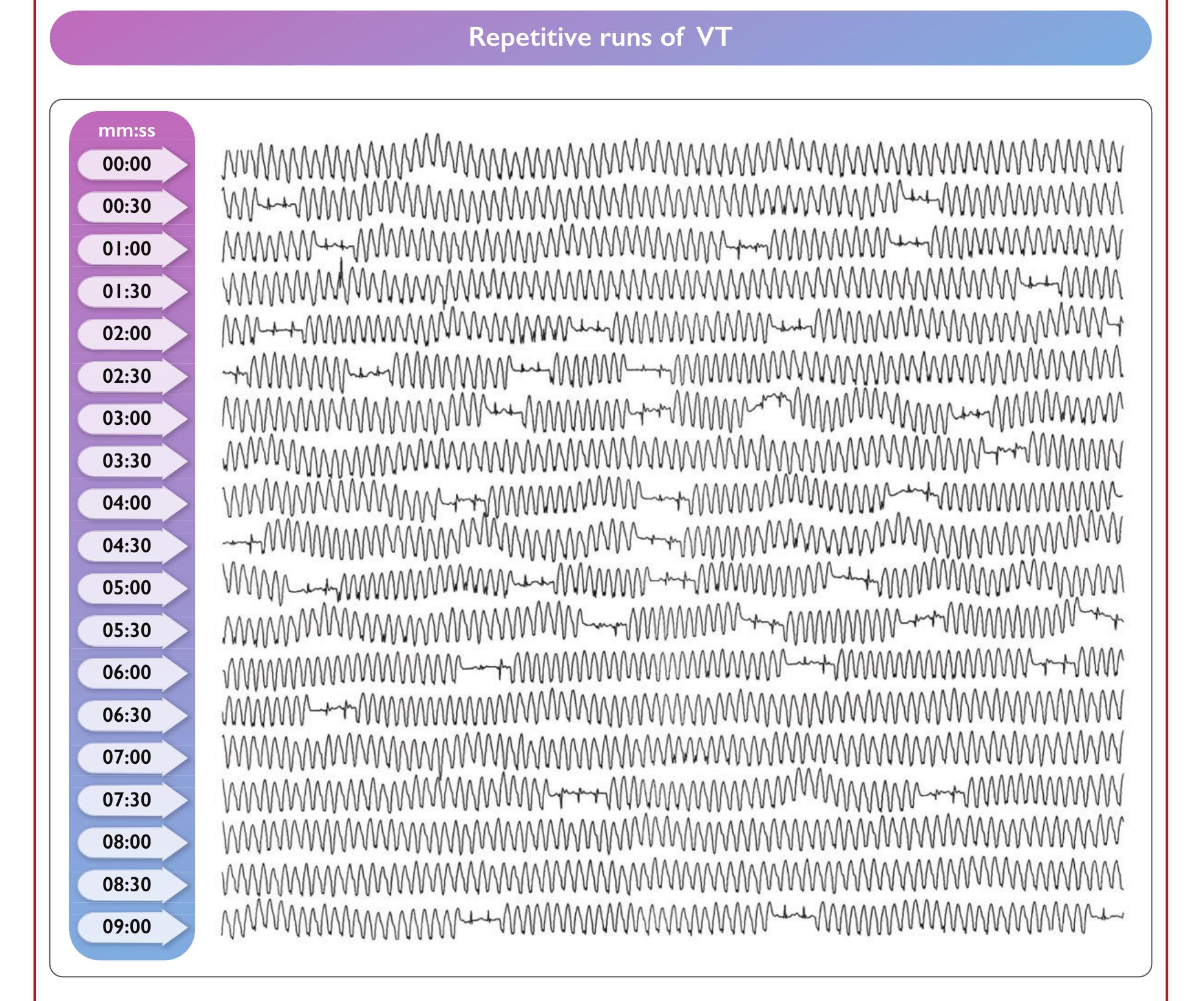 Repetitive runs of ventricular tachycardia interrupted by