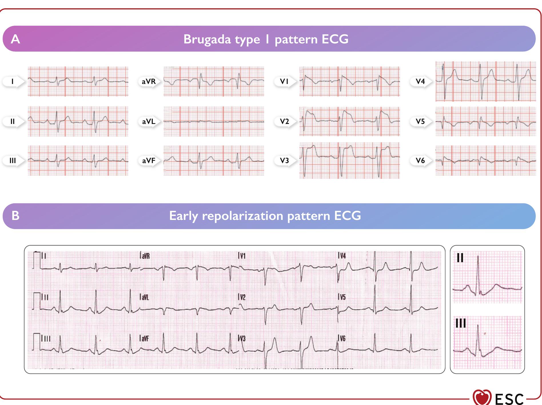 Typical examples of (a) brugada type 1 electrocardiogram,