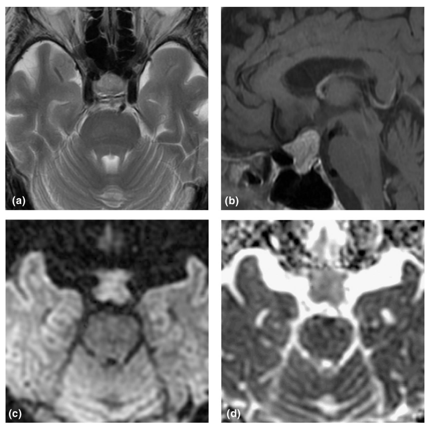 Anon-hemorrhagic pituitary adenoma in a 74-year-old woman.