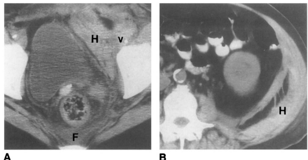 Fic. 10. extraperitoneal hematoma associated with femoral