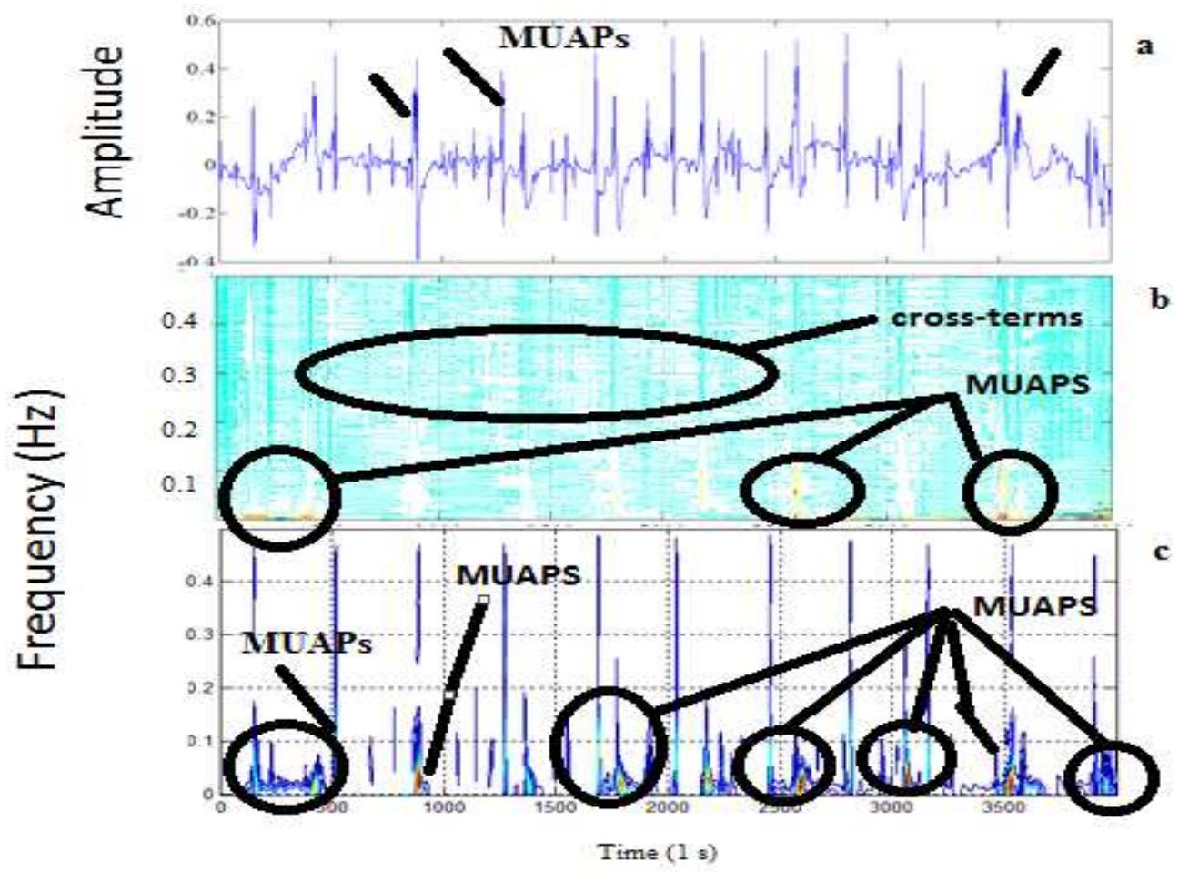 Time-frequency images of normal signal emg: (a) emg signal