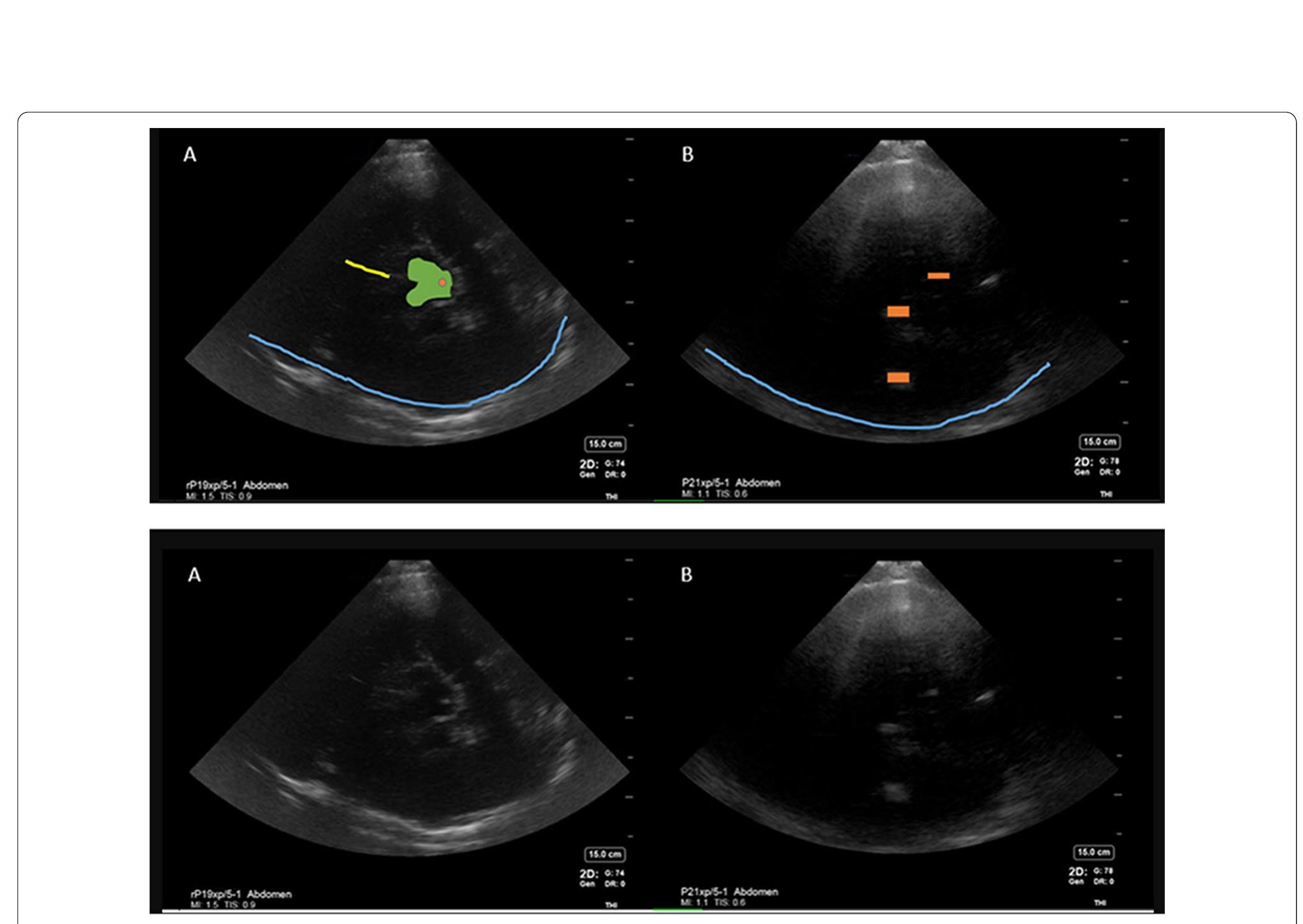 Abdominal presets showing the cerebral aqueduct and choroid