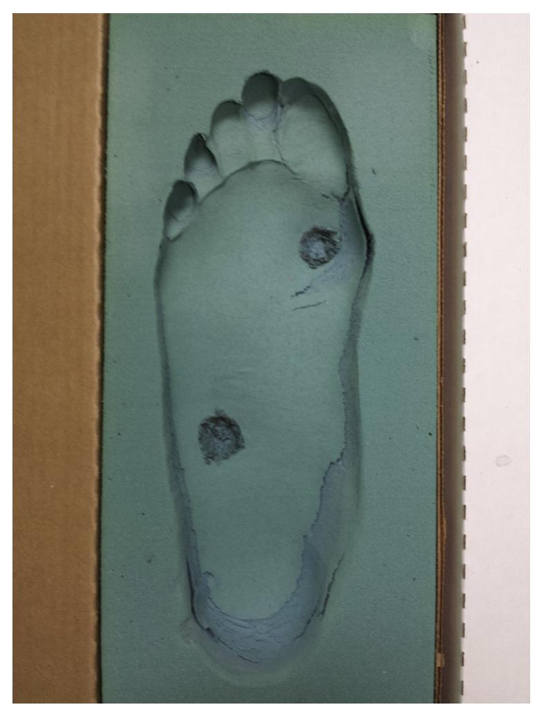 Figure 12 - from Offloading of the Diabetic Foot