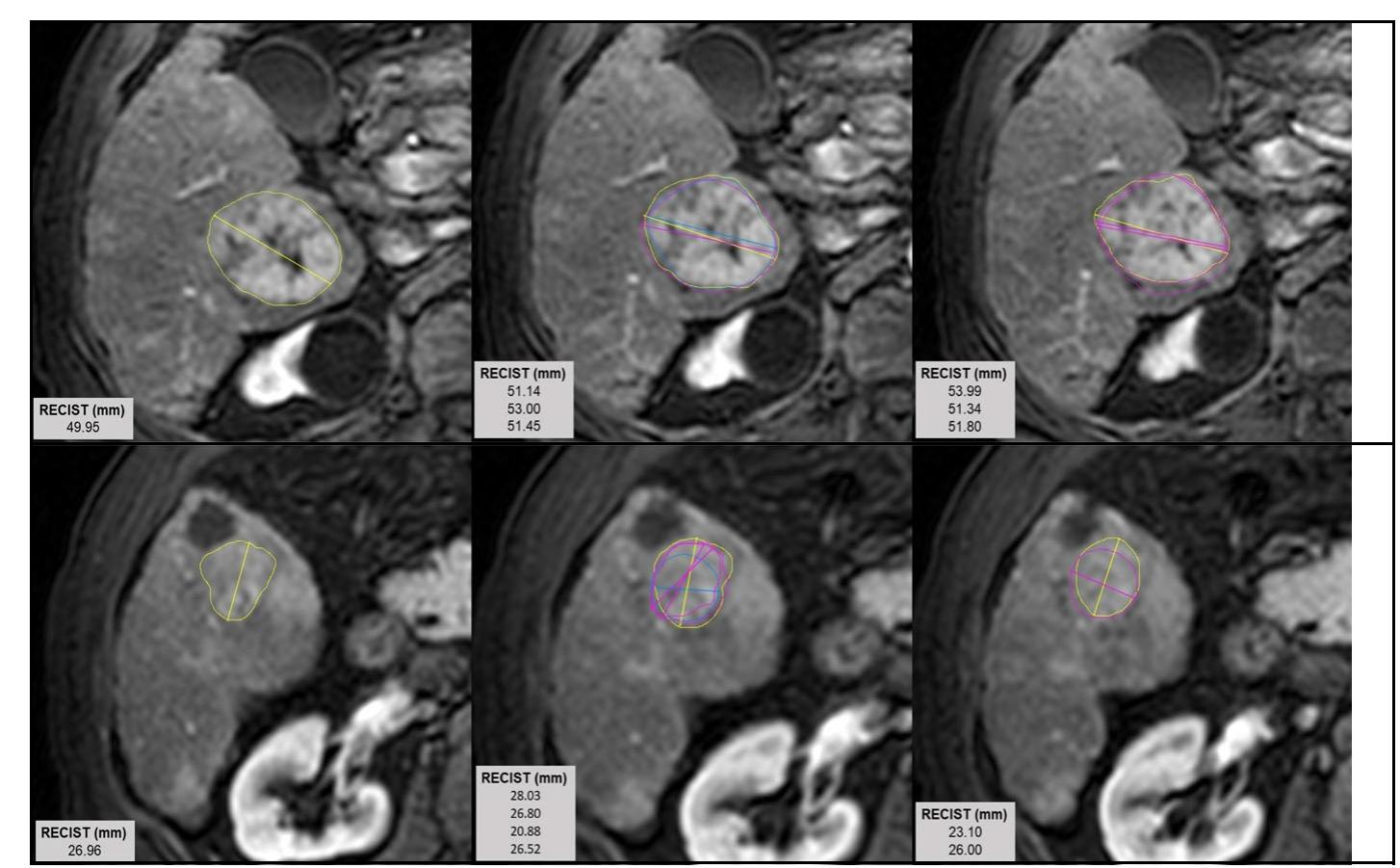 Radiologist-defined recist measurements on two example